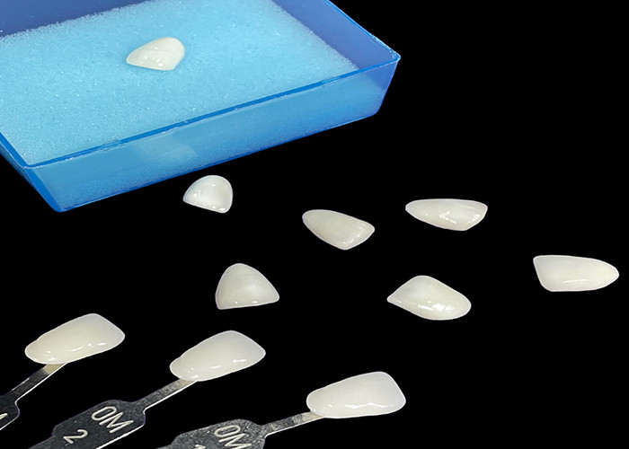 Porcelain Emax Veneer Translucency Bonding For Precise Esthetic ...