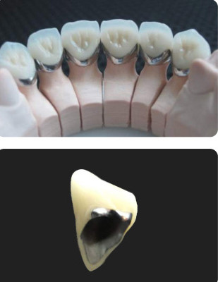 Porcelain Fused To Metal PFM Crown Dental Wear Resistance For ...
