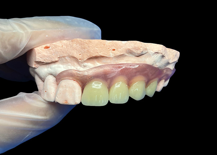 Invisible Flexible Partial dentures for Comfortable Secure Fit and ...
