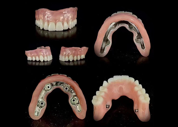 Precise Bar Implant Supported Hybrid Denture Secure Fit Adjustable ...