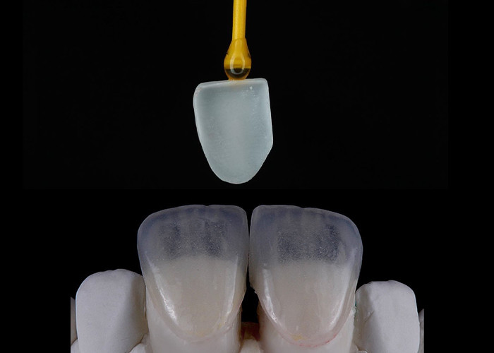 Custom Made Dental Restoration EMAX Veneers Beautifully Aligned Digital ...