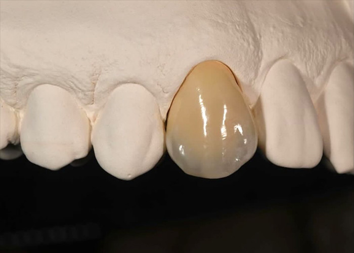 Staining Resistance Solid Zirconia Crown for front teeth posterior teeth