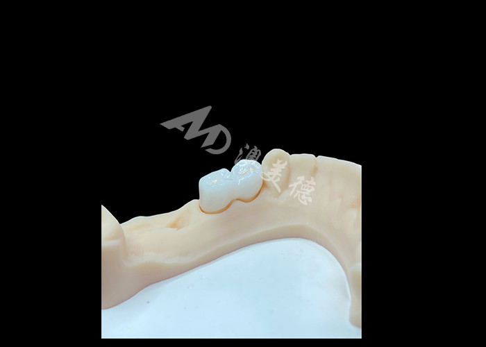 Highly-rated Solid Zirconia Crown For Satisfying Dental Restorations