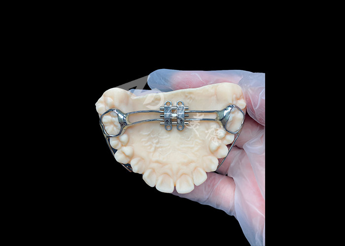 MSE Palatal Expander Innovative Orthodontic Appliances For Effective ...