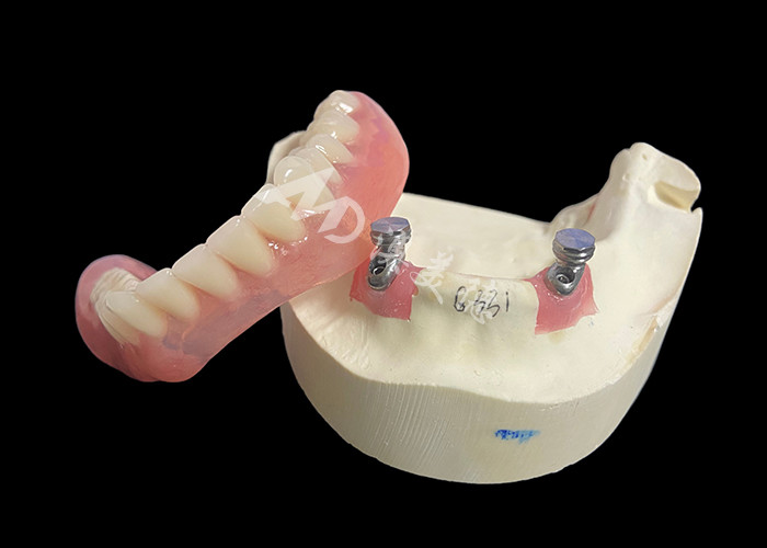 Implant Locator Bar Overdenture Solution For Enhanced Chewing And Speech